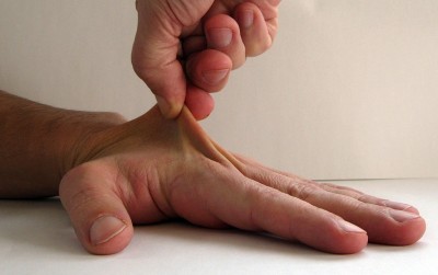 Ehlers-Danlos-Syndrom (EDS) - Ursachen, Symptome, Diagnose, Therapie